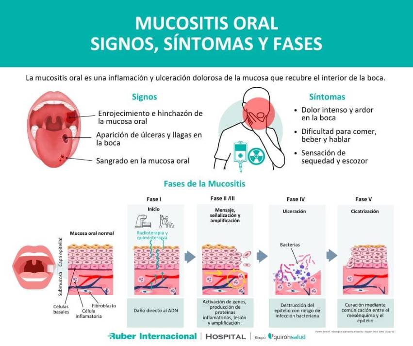 Mucositis Oral: Prevención, diagnóstico y tratamiento